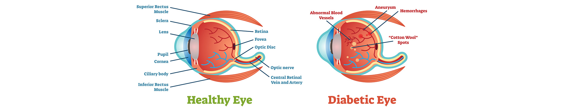 Diabetic Eye Disease Treatment Flagstaff | Contact Lenses Cottonwood